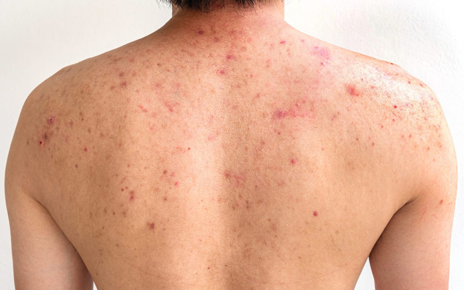 Back Treatments for Acne - Sublime MediSpa